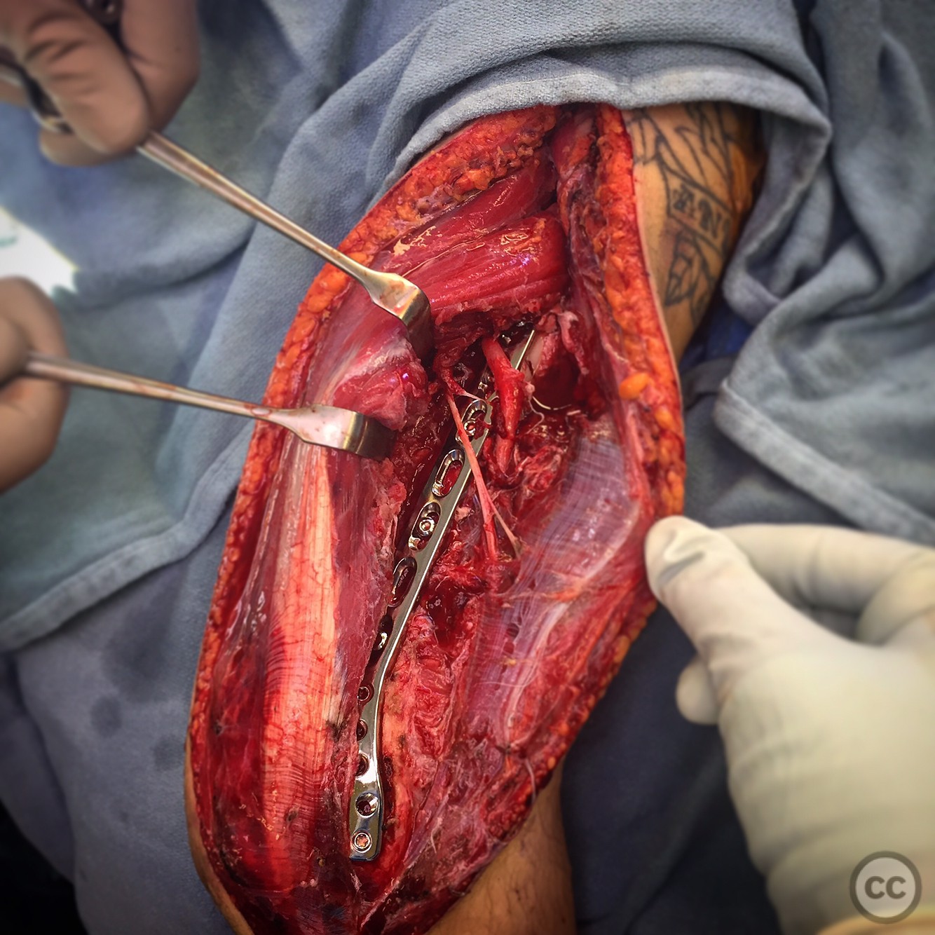 Triceps Sparing Posterior Approach for Humeral Fracture Fixation