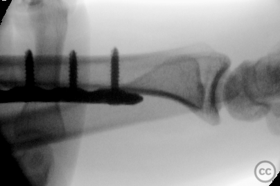 Revision of Galeazzi Fracture Dislocation with TFCC Repair and Ulnar ...
