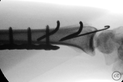 Revision of Galeazzi Fracture Dislocation with TFCC Repair and Ulnar ...