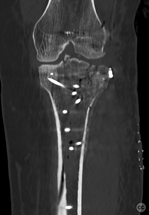 Schatzker 6 tibial plateau with lateral femoral epicondyle osteotomy