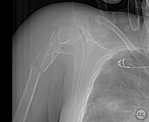 Multifragmentary Proximal Humerus Fracture with Scapula Fracture in a ...