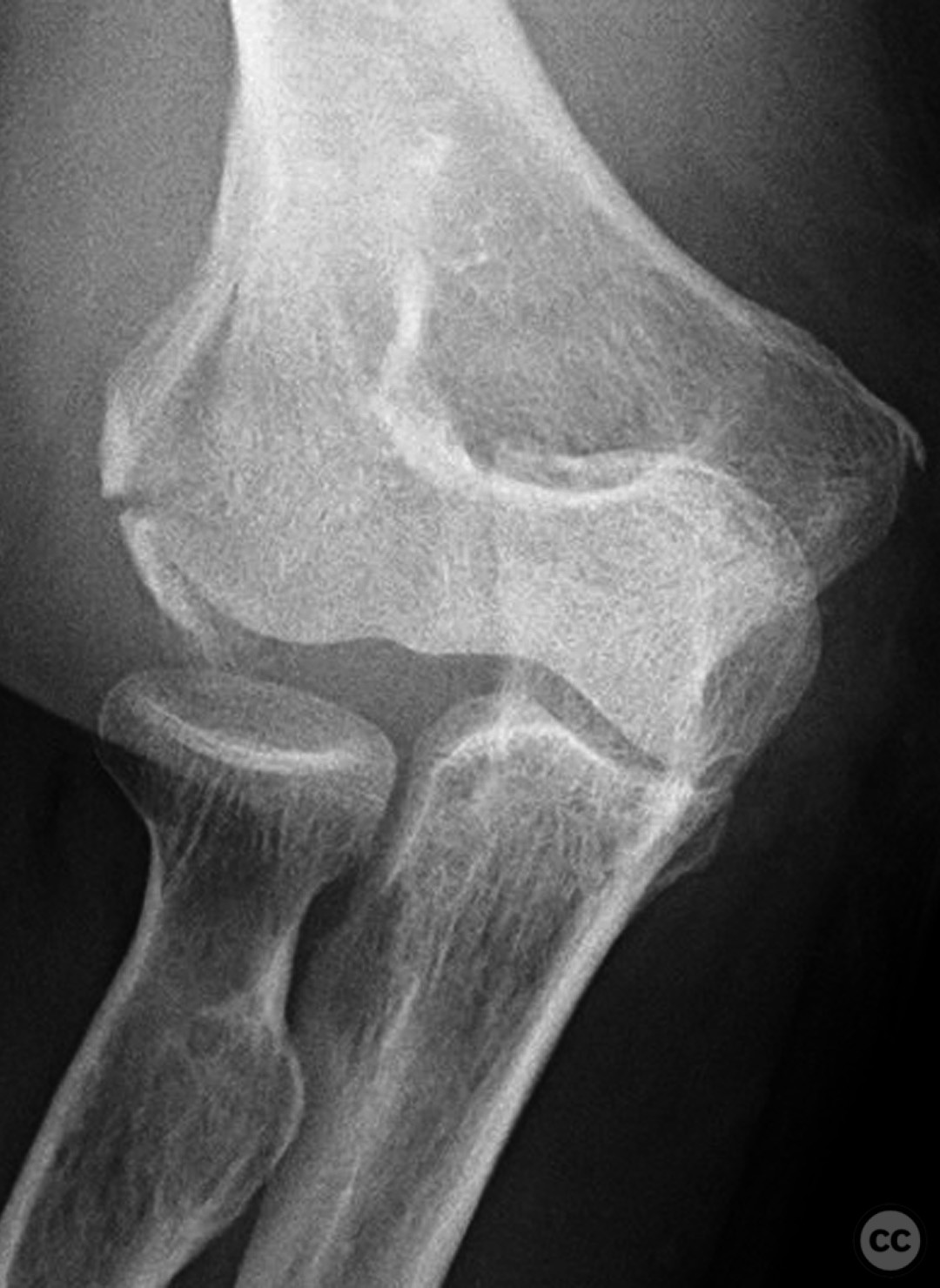 Dubberly 2B articular humerus fracture - skinny wire and radial plate ...