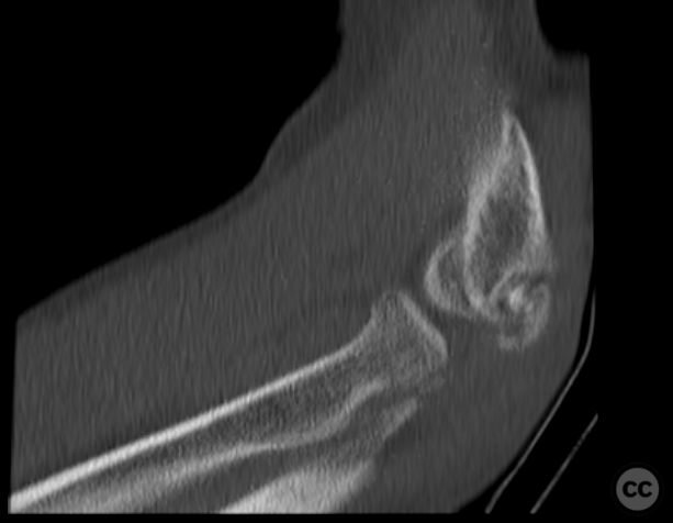C3 articular humerus fracture with ulnar column vertical shear injury