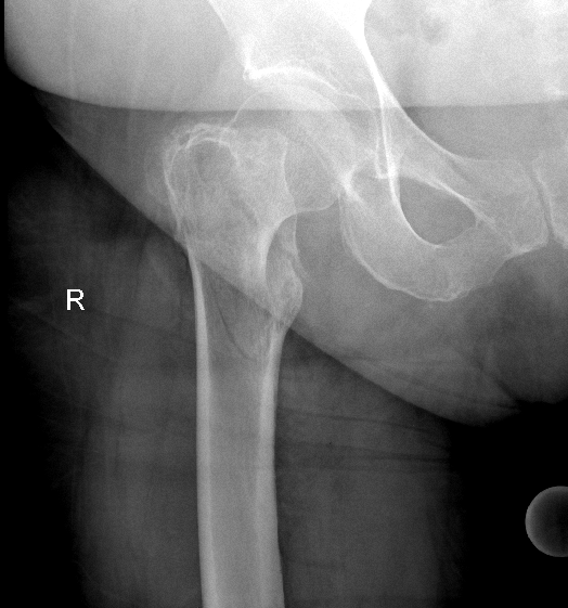 Comminuted subcapital and per/subtrochanteric femur fracture