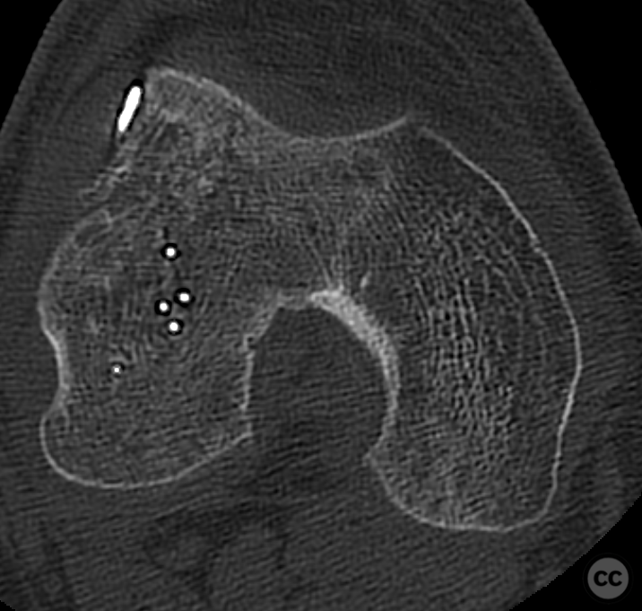 Destructive osteochondral fracture of the lateral femoral condyle ...