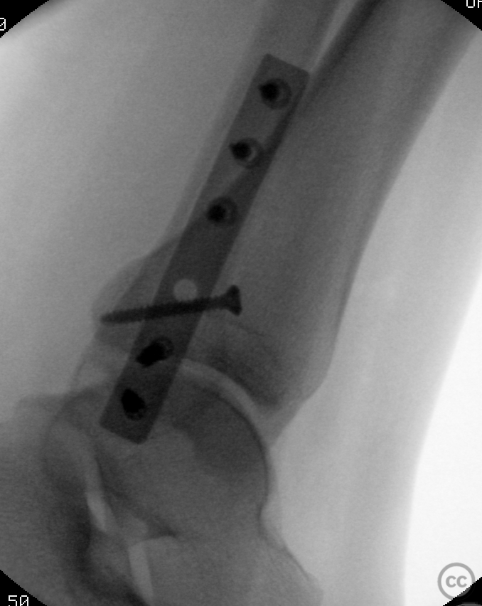 Simple SER Weber B fibula fracture