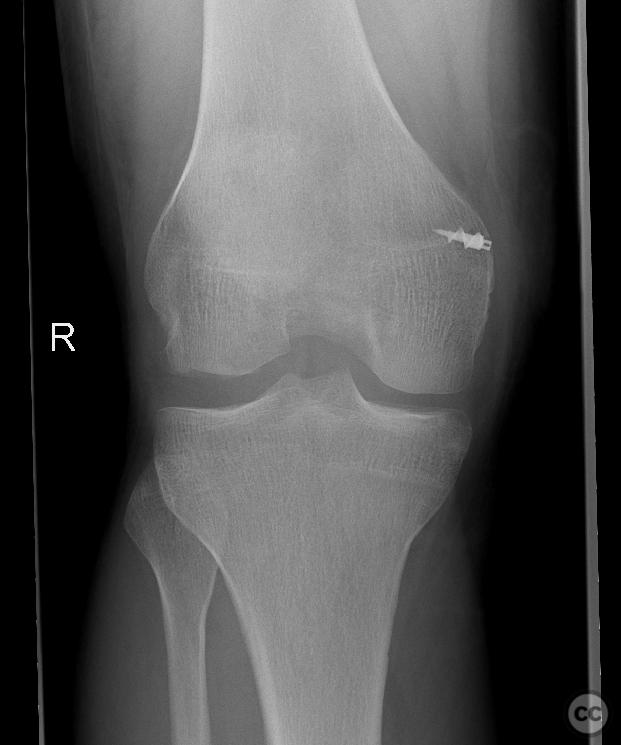 Destructive osteochondral fracture of the lateral femoral condyle ...
