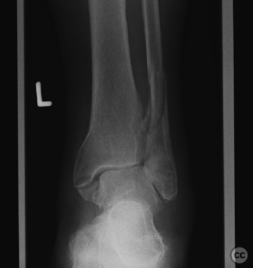 Chaput tubercle fracture in an adult bimalleolar ankle fracture