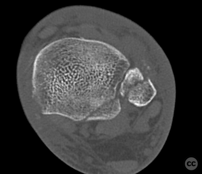 Pronation Abduction (PAb) ankle fracture with Mason 2A lateral plafond ...