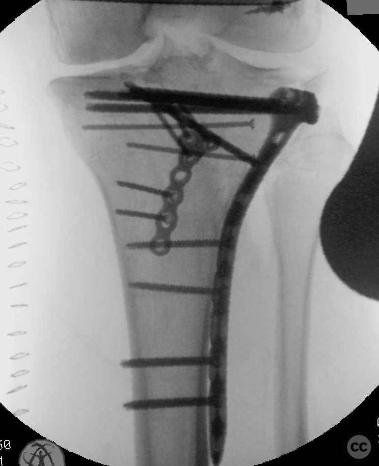 Posterolateral approach to the tibial plateau with femoral epicondylar ...