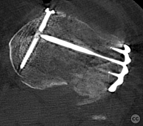 Schatzker 6 tibial plateau with lateral femoral epicondyle osteotomy