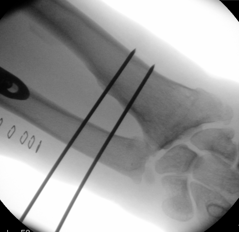 Essex-Lopresti fracture-dislocation
