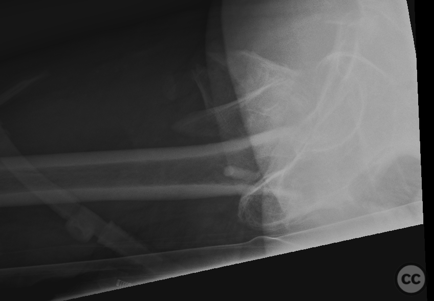 Failure of fixation - Gamma nail cut-out and arthroplasty revision