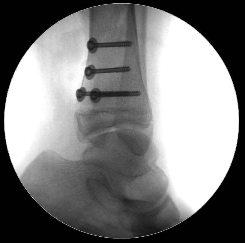 Salter Harris II distal tibia fracture - minimally invasive screw fixation
