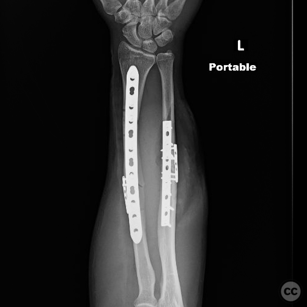 Segmental Both Bones Forearm Fracture in a Polytrauma Patient