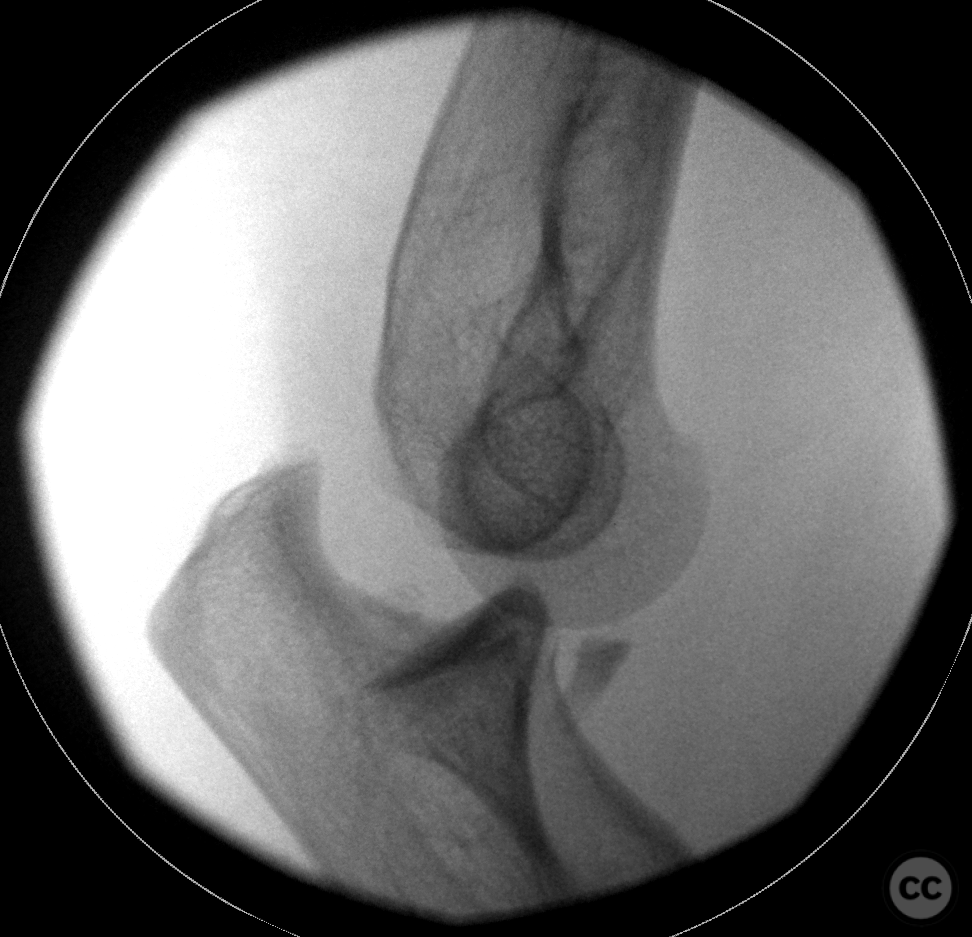 PMRI following elbow dislocation with pMCL insufficiency
