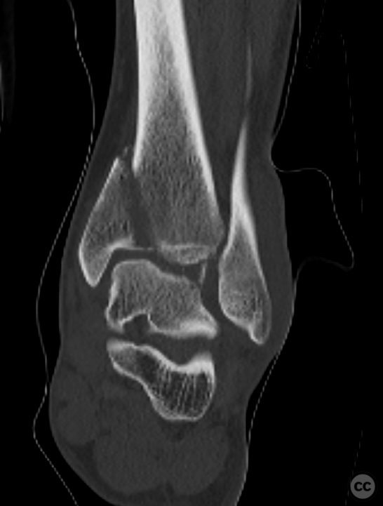 Anterior fracture dislocation with impression fracture of the articular ...