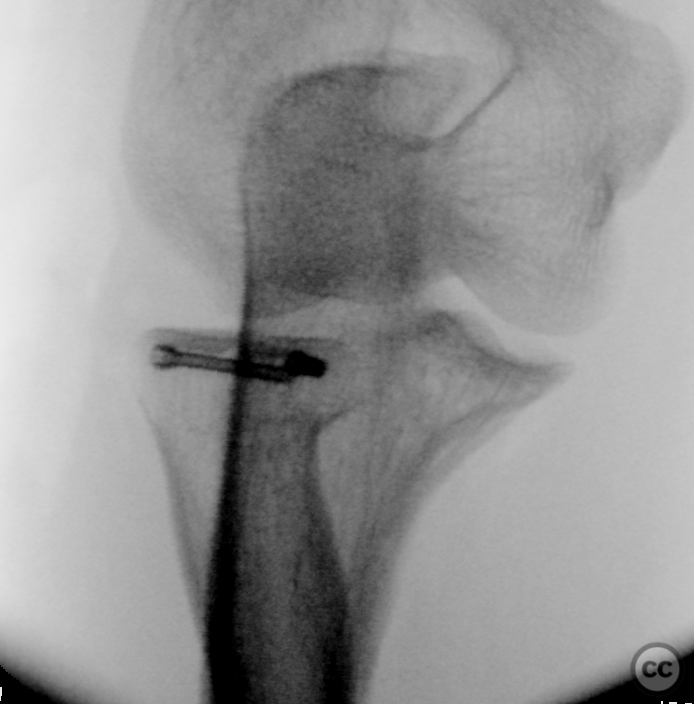 Mason II Radial Head Fracture