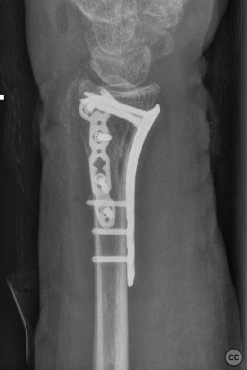 Radiocarpal distraction reduction technique for distal radius fracture