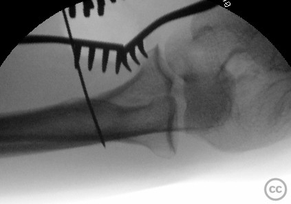 Distal biceps bicortical endobutton fixation