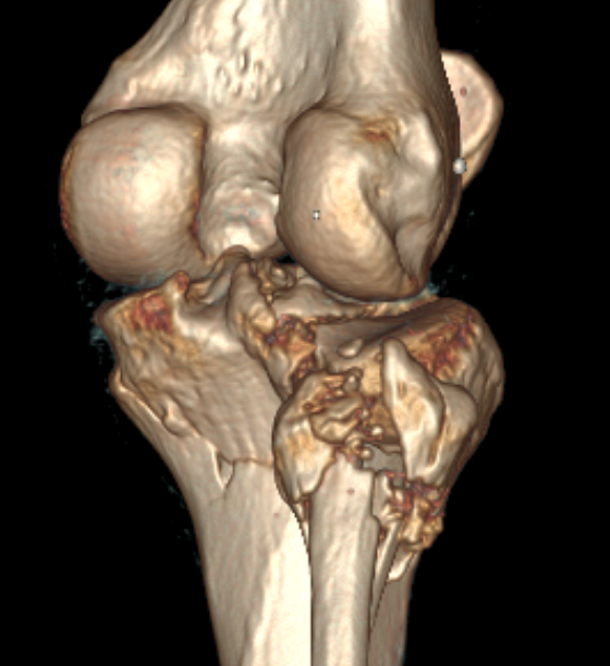 Schatzker VI tri-condylar fracture with pseudo PLC disruption