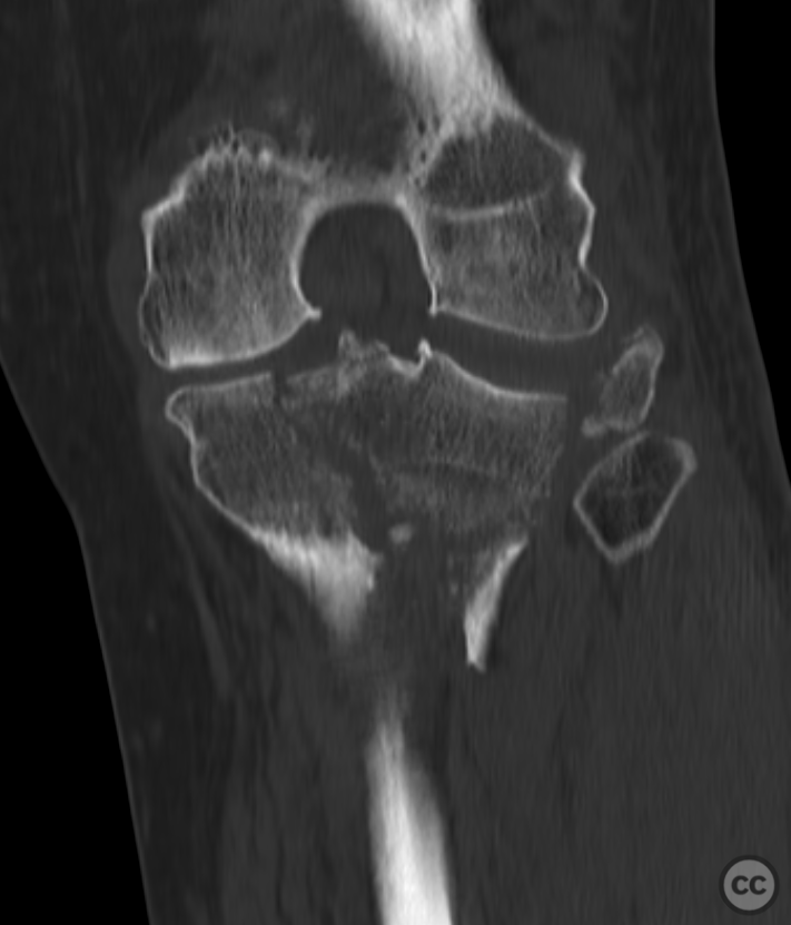 Posterolateral approach to the tibial plateau with femoral epicondylar ...