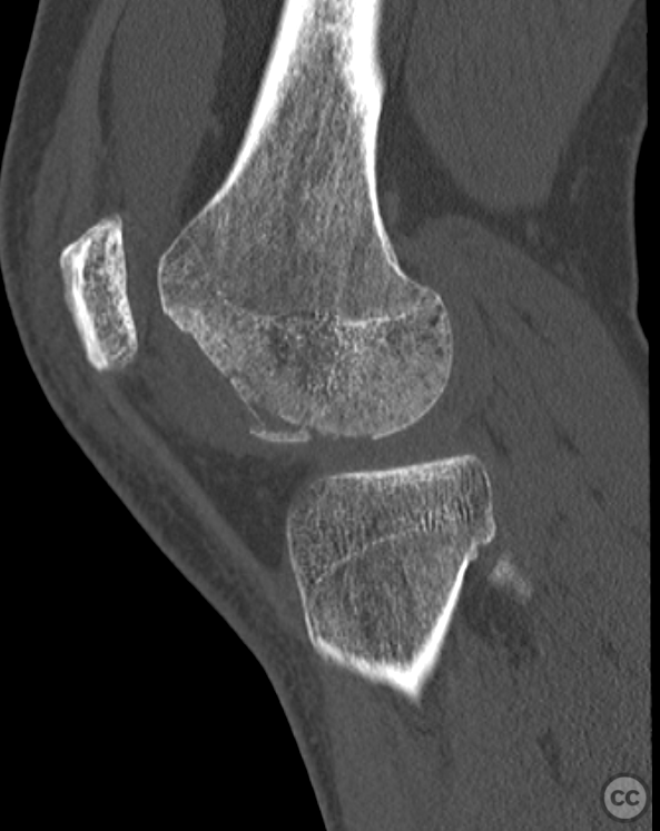 Destructive osteochondral fracture of the lateral femoral condyle ...