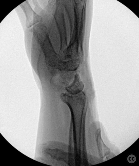 Scaphoidectomy and four corner arthrodesis