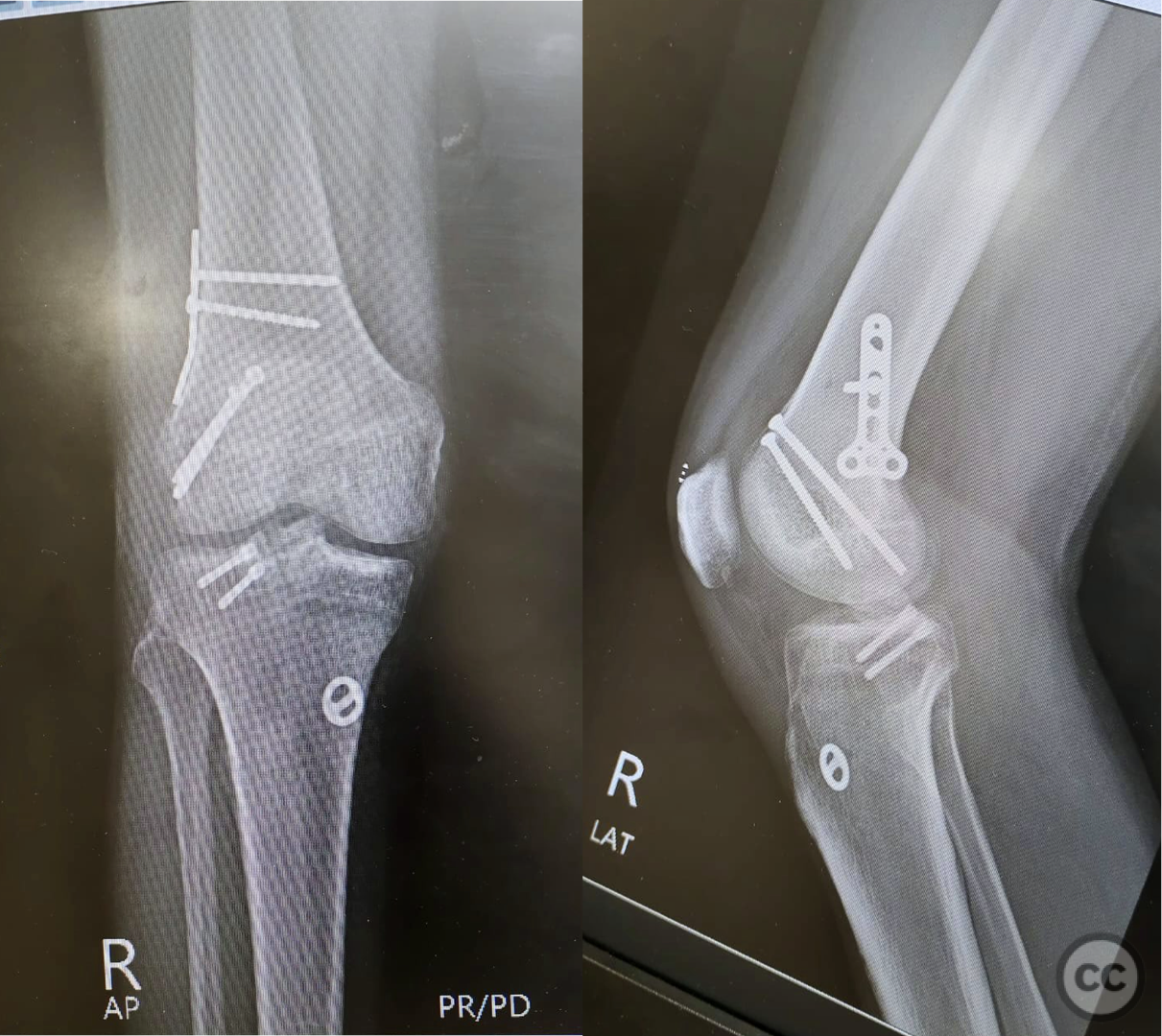 Ipsilateral lateral condyle Hoffa's fracture with PCL avulsion fracture ...