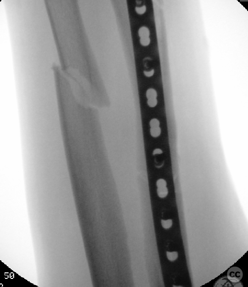 Henry's approach to a segmental radial shaft fracture