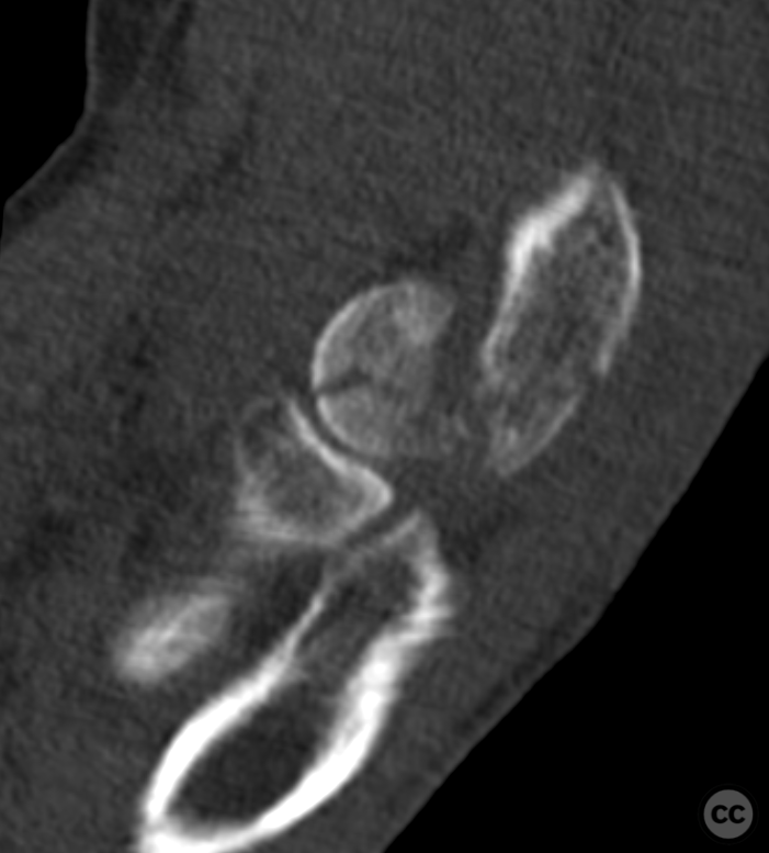 Dubberly 3/4 shear plus comminuted trans condylar trochlear fracture ...