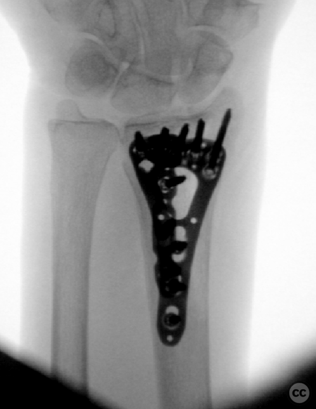 Dorsal plate fixation of the dorsoulnar fragment in a C3 radius fracture