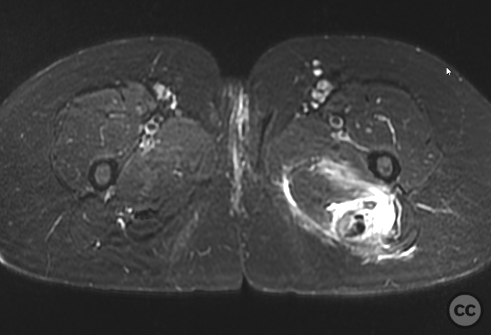 Proximal hamstring tendon avulsion