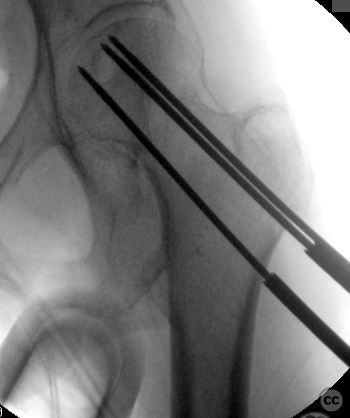 Cannulated screw fixation of a Garden I subcapital femoral neck fracture