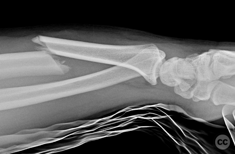 Revision of Galeazzi Fracture Dislocation with TFCC Repair and Ulnar ...