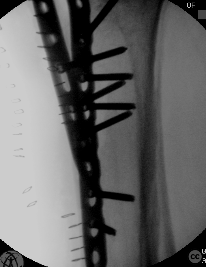 Varus hyperextension tibial plateau fracture