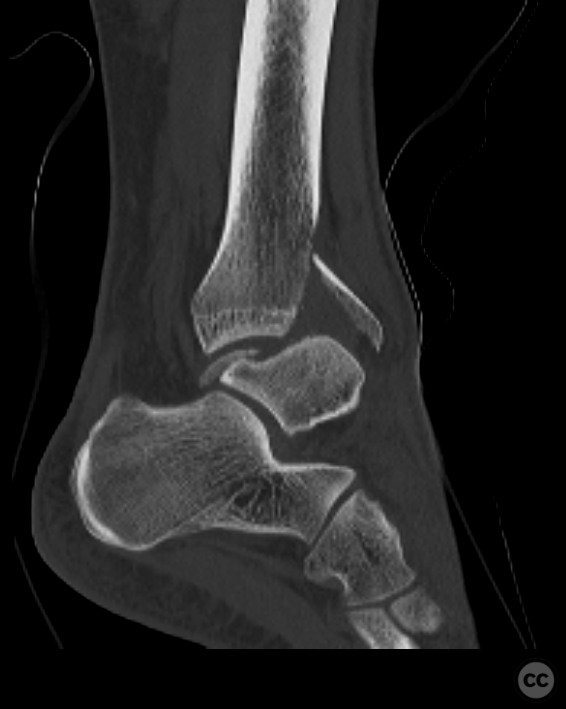 Anterior fracture dislocation with impression fracture of the articular ...