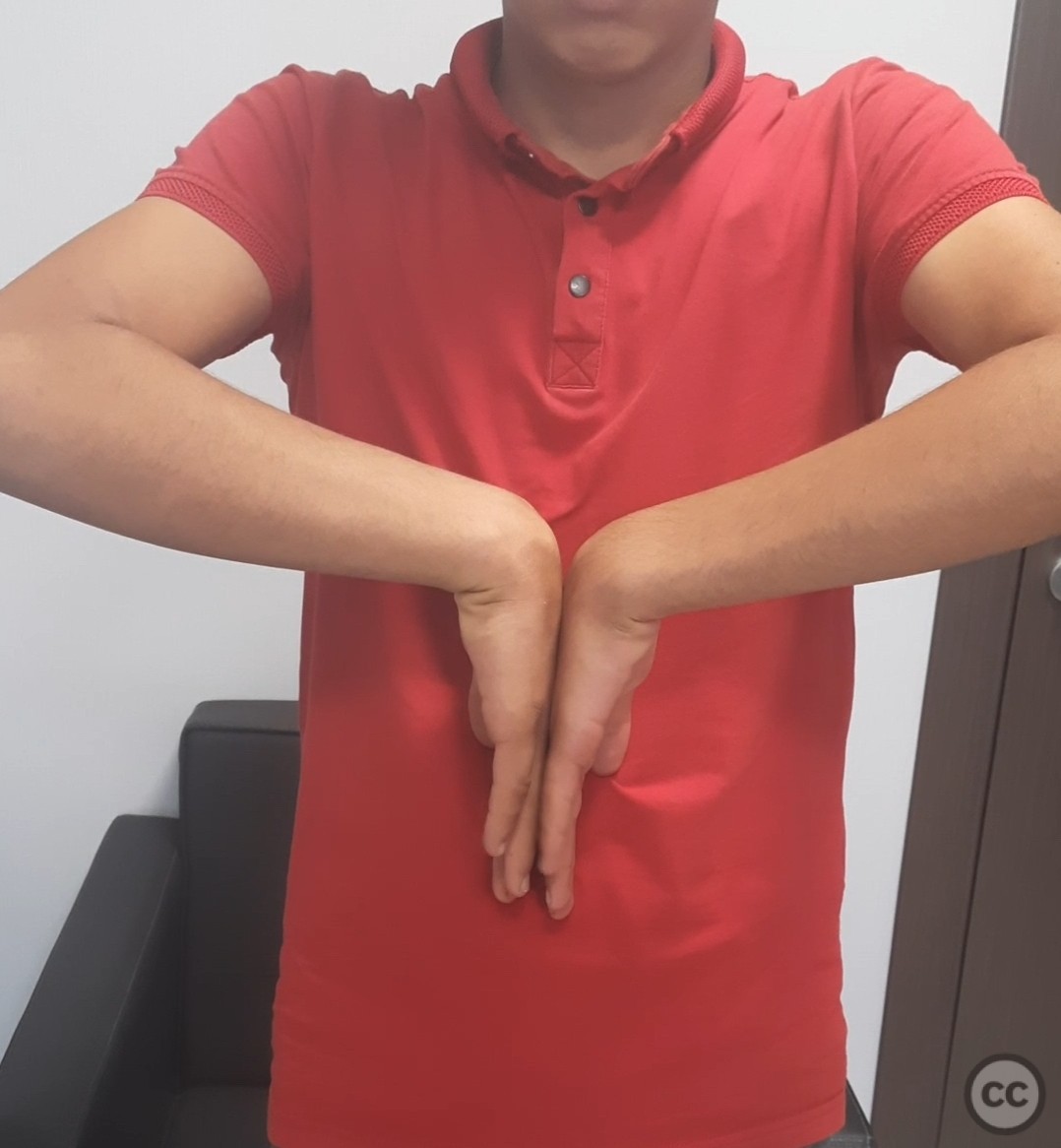 Radius distal Salter Harris type 2 fracture, closed reduction PP