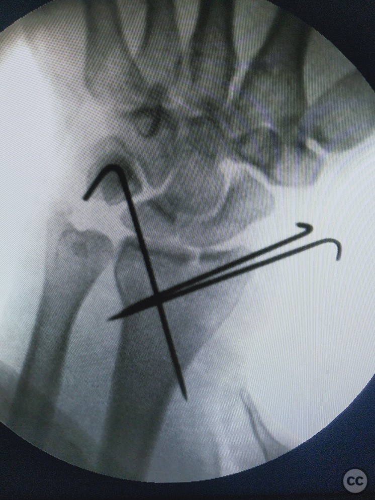 Percutaneous k-wire fixation of an intraarticular distal radius fracture