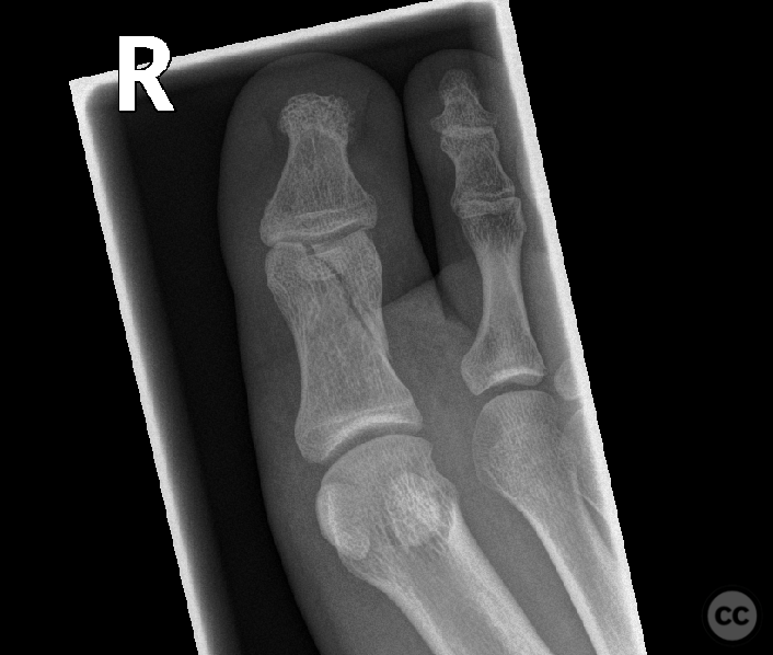 D1 prox phalanx condyle fracture