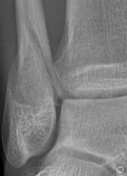 SER ankle injury with occult PITFL + deltoid instability