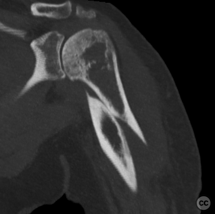 Prox 1/3 humeral shaft fracture with concomitant GH osteoarthritis