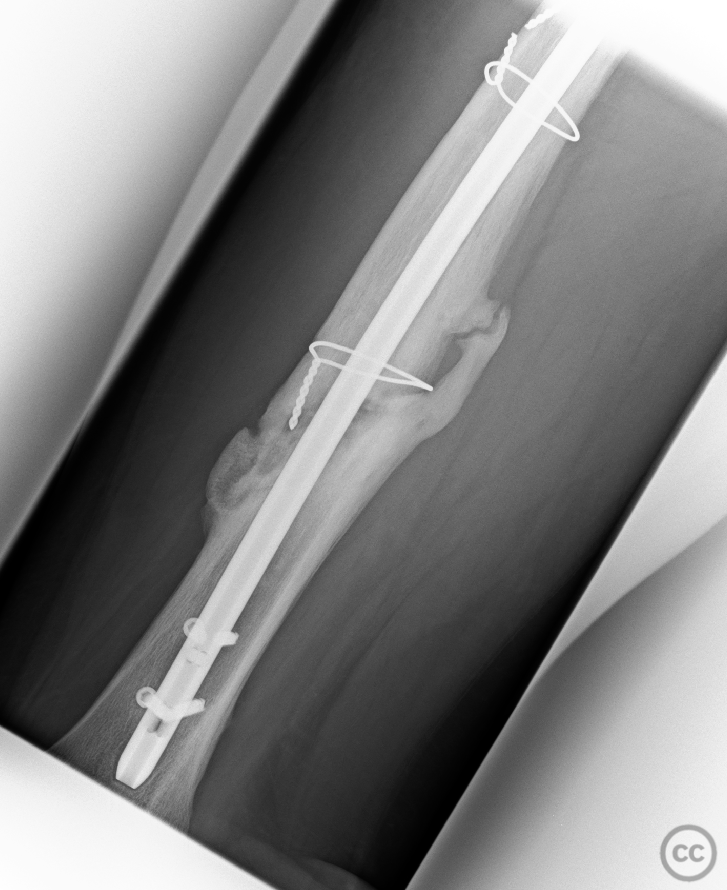 Closed segmental comminuted femoral fracture