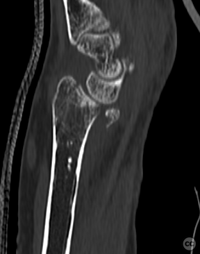 Volar Barton's volar rim fracture distal radius