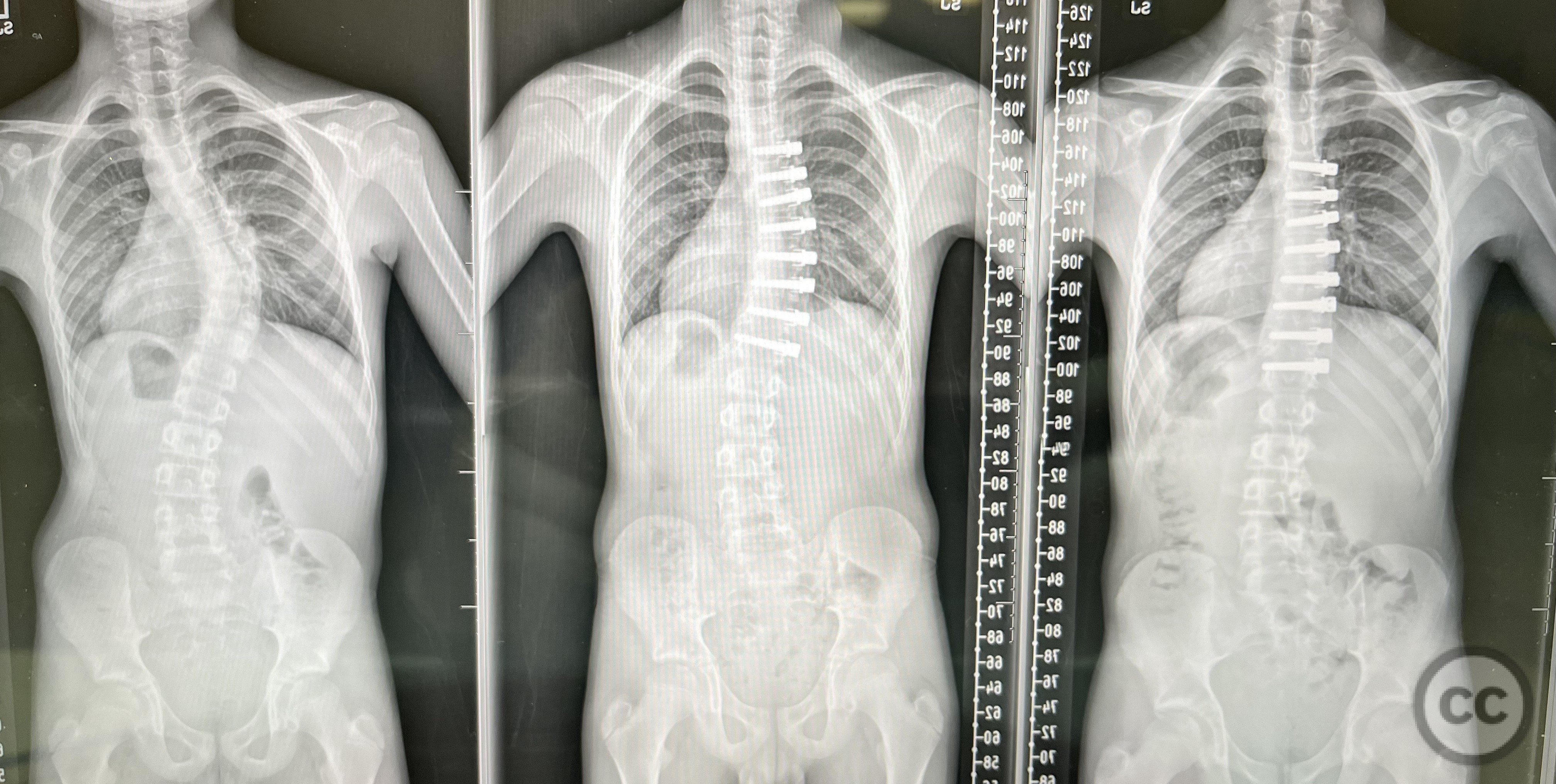 Vertebral Body Tethering For Scoliosis