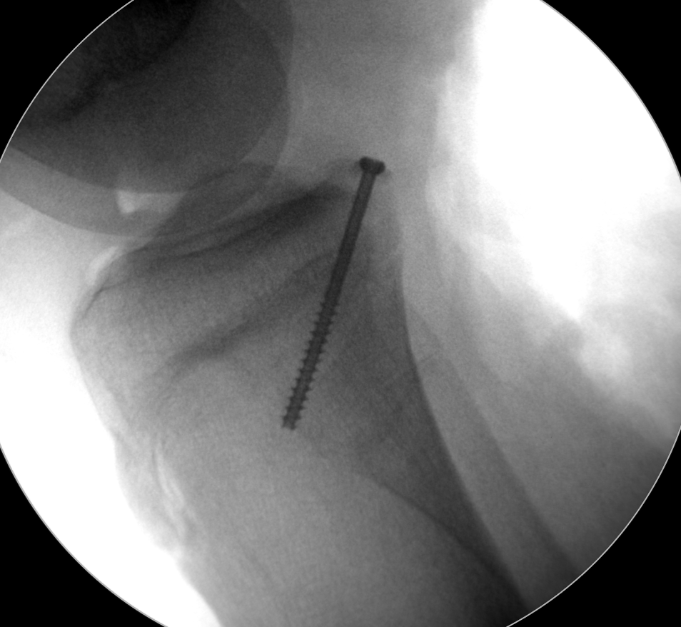 Tibial bony PCL Avulsion - open screw osteosynthesis