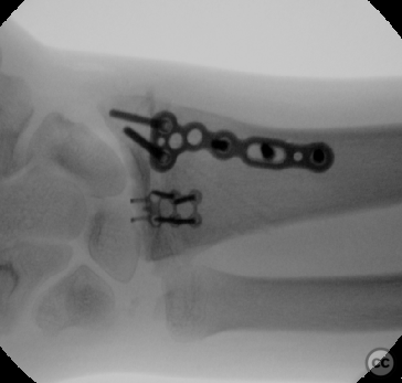 Malunion Salter III distal radius fracture dislocation