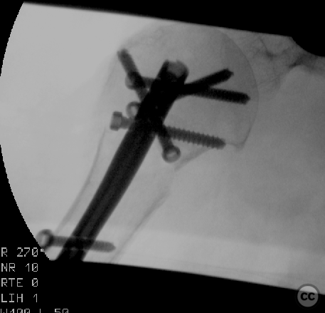 Displaced surgical neck of humerus fracture with brachial plexus ...