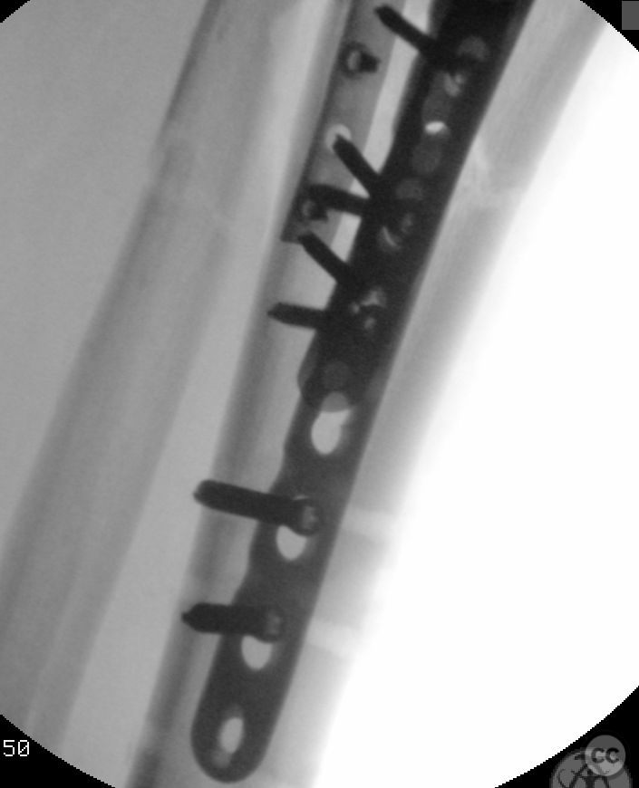 Combined tibial metaphysis and plateau fracture