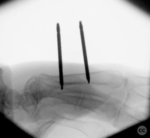 Radiocarpal distraction reduction technique for distal radius fracture